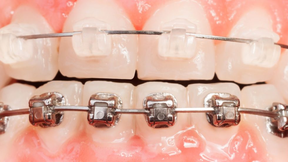 Les bagues et l'orthodontie : 3 grandes catégories d'appareils dentaires